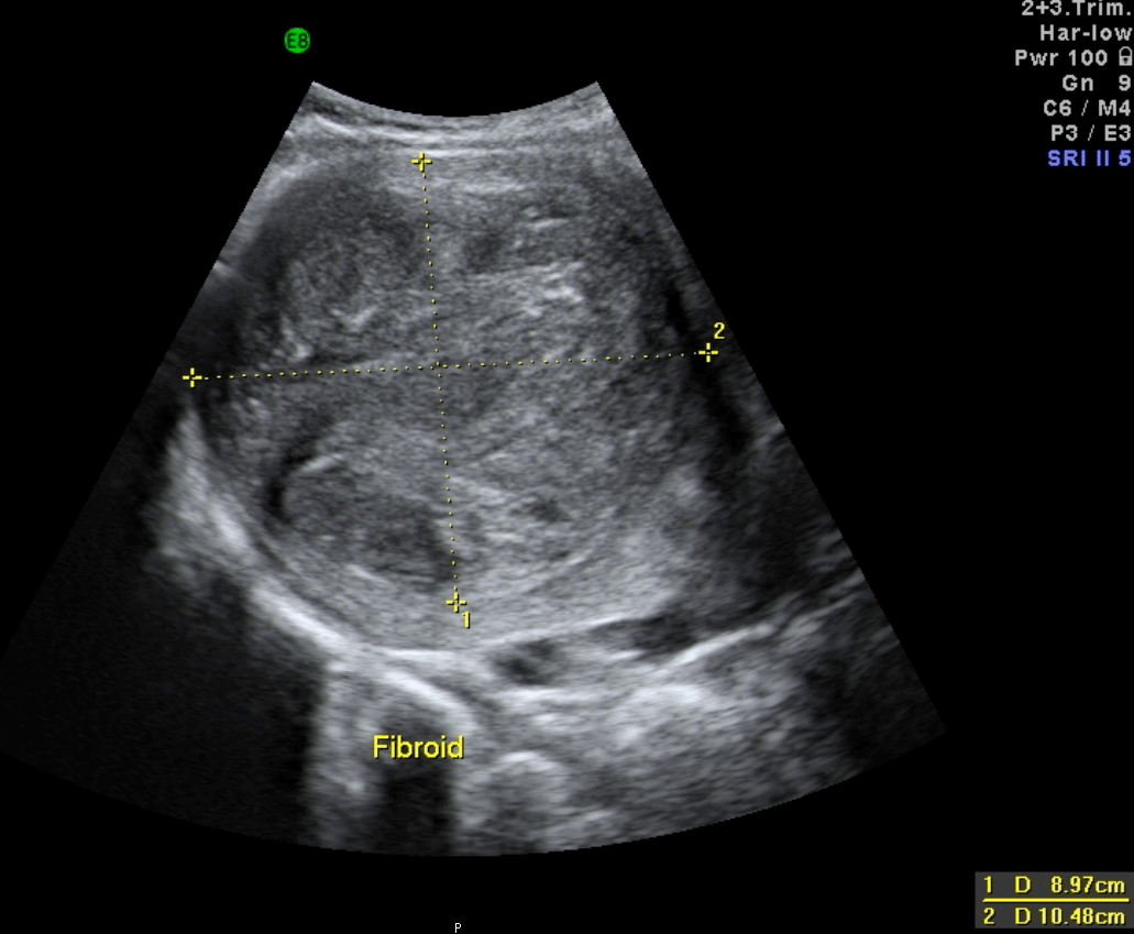 Bab 4 – Adenomiosis – Melaka Fertility – Selva’s Fertility, Obstetrics ...