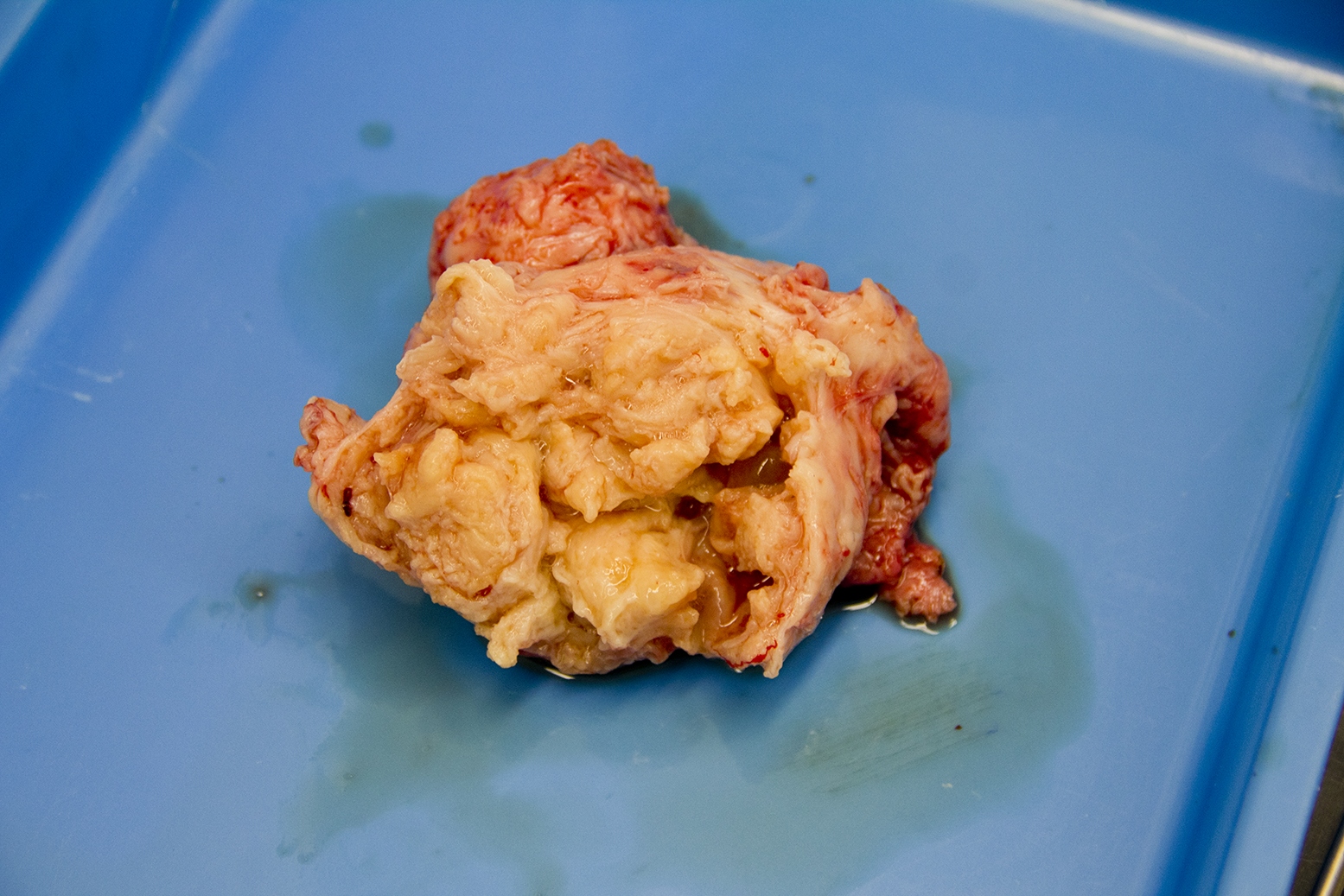 Chapter 2 – Uterine Fibroids – Melaka Fertility